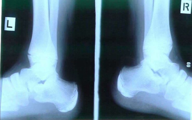 Podiatry Case Study on Sever's Disease - Proud to be a Pod